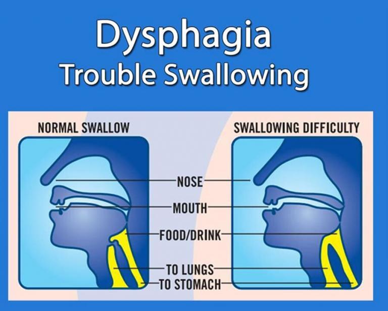 Dysphagia Definition Dysphagia PocketDrugGuide